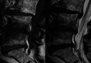 Modic変性は圧迫骨折との鑑別が難しい｜交通事故の後遺障害 - メディカルコンサルティング合同会社