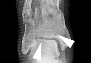 ピロン骨折の後遺症と後遺障害認定ポイント｜脛骨天蓋骨折｜交通事故 - メディカルコンサルティング合同会社