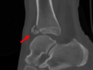ピロン骨折の後遺症と後遺障害認定ポイント｜脛骨天蓋骨折｜交通事故 - メディカルコンサルティング合同会社